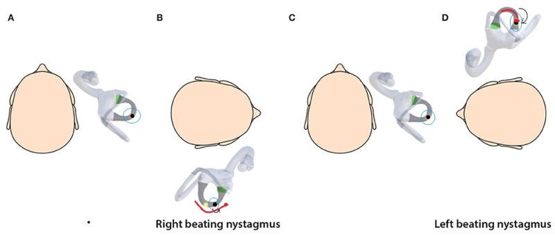양성 발작성 현기증(BPPV) : 네이버 블로그