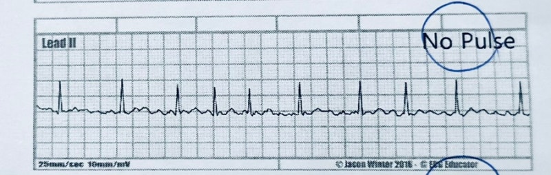 PEA : 무맥성 전기 활동, CPR EKG 리듬, unshockable rhythm, 에피네프린 적응증 : 네이버 블로그
