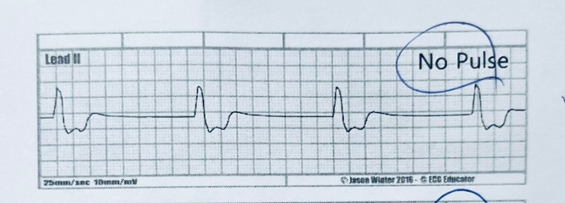 PEA : 무맥성 전기 활동, CPR EKG 리듬, unshockable rhythm, 에피네프린 적응증 : 네이버 블로그