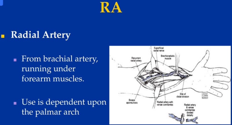 의학용어 PCI & 관상동맥우회술 CAG 비교하기 - 요골동맥(radial artery) vs 복재정맥(Saphenous ...