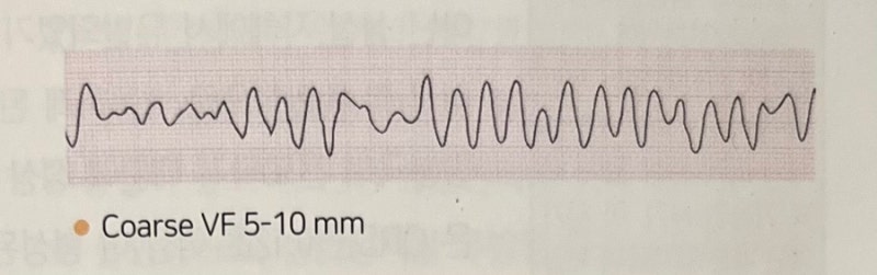 Vfib : 심실세동, Ventricular Fibrillation, EKG 리듬, shockable rhythm, 제세동기 ...