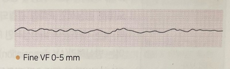 Vfib : 심실세동, Ventricular Fibrillation, EKG 리듬, shockable rhythm, 제세동기 ...