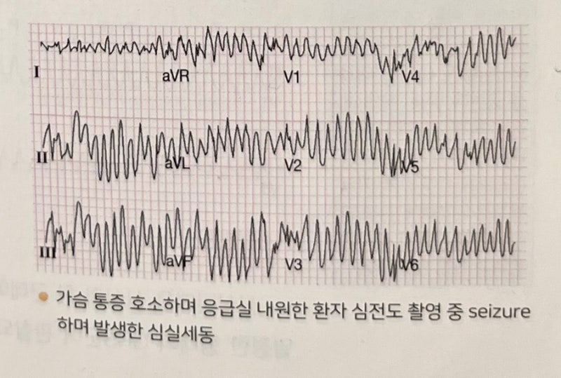 Vfib : 심실세동, Ventricular Fibrillation, EKG 리듬, shockable rhythm, 제세동기 ...