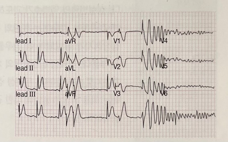 Vfib : 심실세동, Ventricular Fibrillation, EKG 리듬, shockable rhythm, 제세동기 ...