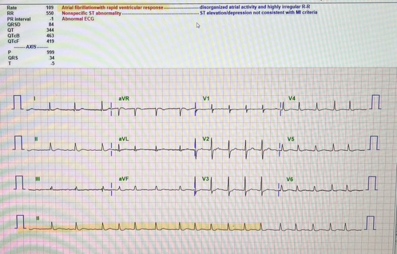 Afib : 심방세동, Atrial Fibrillation, EKG 리듬, AF 원인 / 증상 / 치료방법 : 네이버 블로그