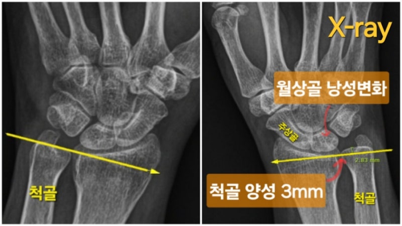 척골 충돌 증후군의 치료 완벽한 척골단축술 강서 K 병원 홍성우 원장 네이버 블로그