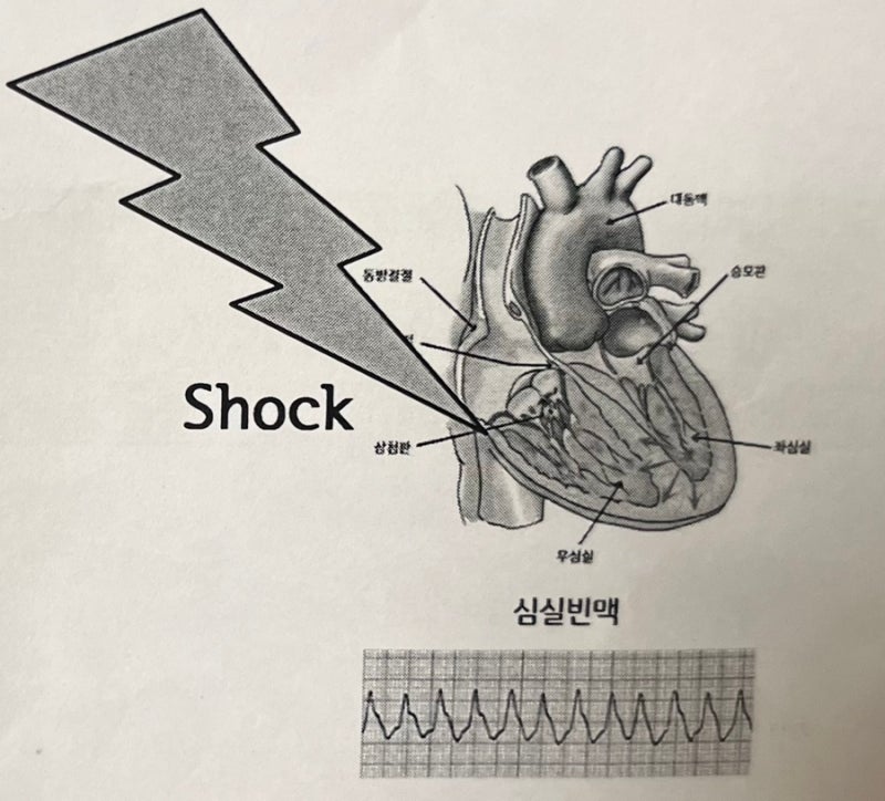 Vtach : 심실빈맥, Ventricular tachycardia, pulseless VT, EKG 리듬 / 제세동기 적응증 ...