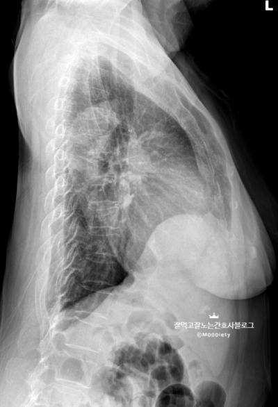 흉부X선 이해하기 : Chest PA/AP/ Chest PA/Lat & Chest Lat Decubitus & Chest ...