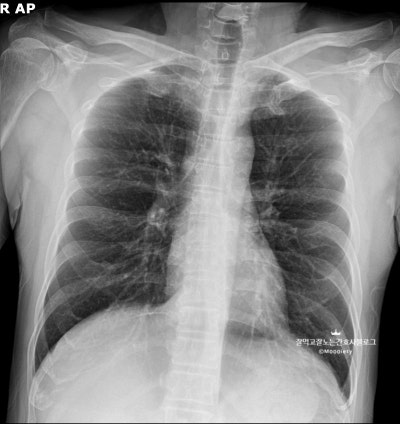 흉부X선 이해하기 : Chest PA/AP/ Chest PA/Lat & Chest Lat Decubitus & Chest ...