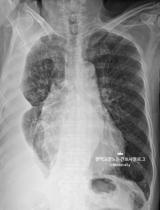 흉부X선 이해하기 : Chest PA/AP/ Chest PA/Lat & Chest Lat Decubitus & Chest ...