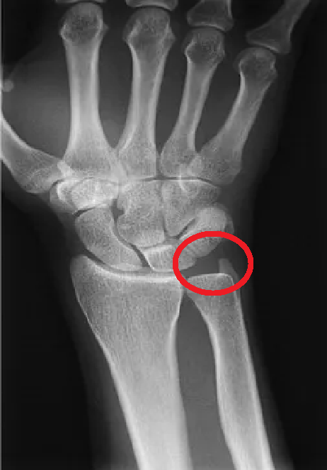 TFCC injury or 척골충돌증후군이 정말 맞을까? 보존적 치료에 대해 : 네이버 블로그