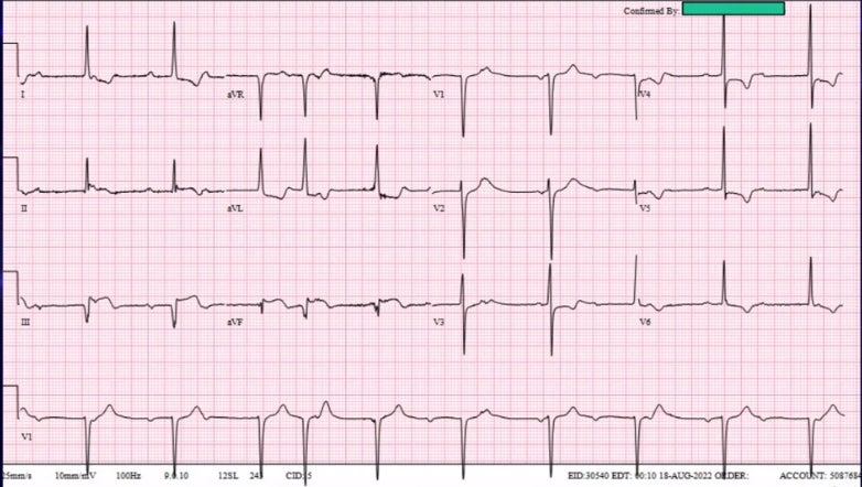 심전도 이상, AV dissociation without complete heart block : 네이버 블로그