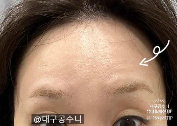 부산 스킨보톡스 후기 효과 통증 부작용 주기 가격 멍 엠보 네이버 블로그