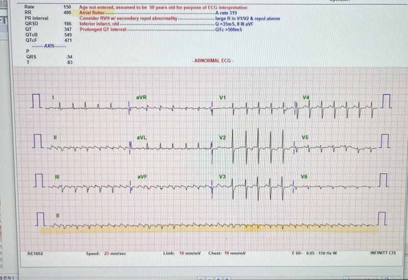 A-flutter : 심방조동, 의학용어 AF , Atrial Flutter, EKG 리듬, 원인 / 증상 / 치료방법 ...