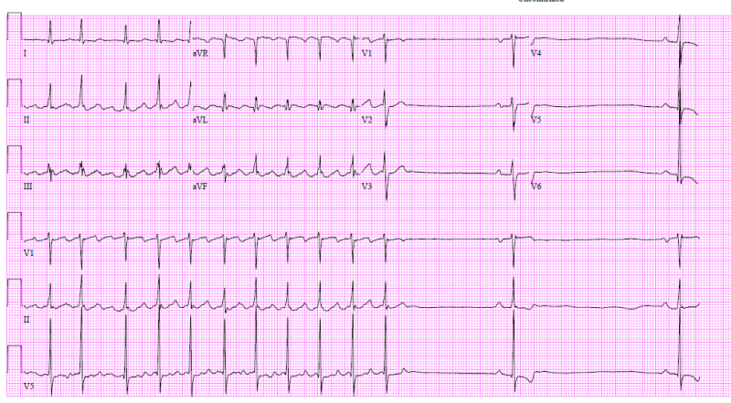 Sick Sinus Syndrome(SSS, 동기능 부전 증후군) : 네이버 블로그