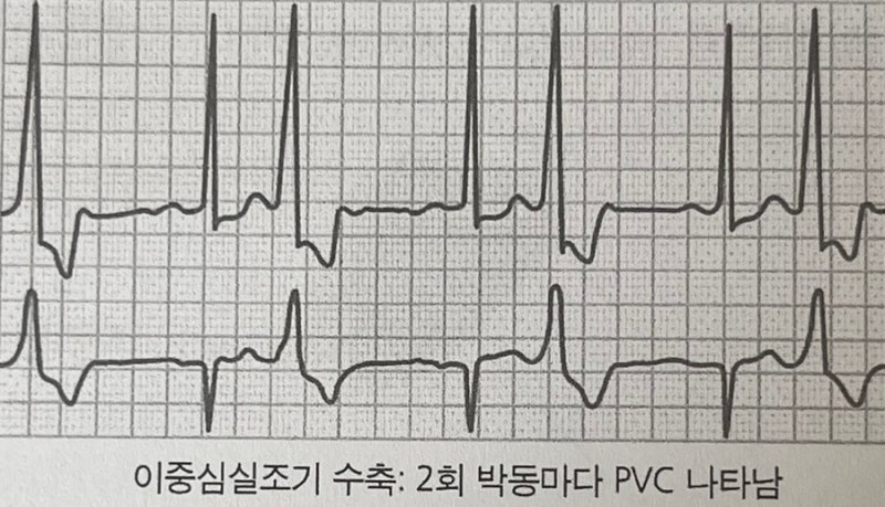 심실조기수축 : 의학용어 PVC, VPC / premature ventricular contraction EKG 리듬 ...