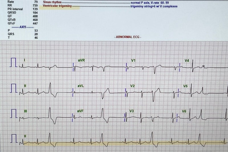 심실조기수축 : 의학용어 PVC, VPC / premature ventricular contraction EKG 리듬 ...