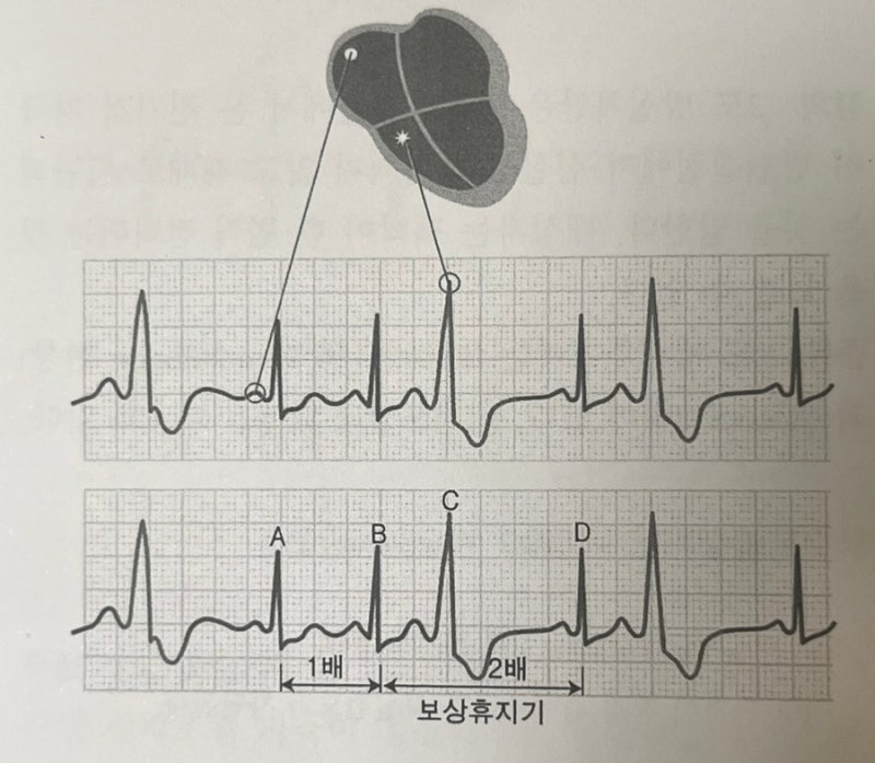 심실조기수축 : 의학용어 PVC, VPC / premature ventricular contraction EKG 리듬 ...
