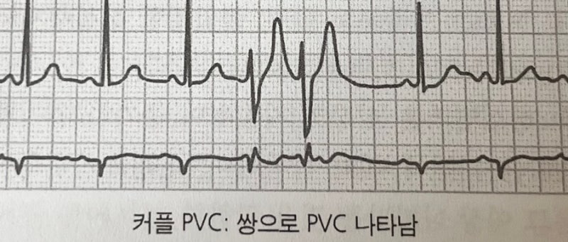 심실조기수축 : 의학용어 PVC, VPC / premature ventricular contraction EKG 리듬 ...