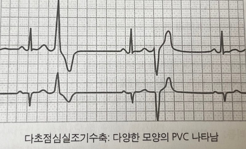 심실조기수축 : 의학용어 PVC, VPC / premature ventricular contraction EKG 리듬 ...