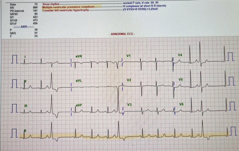 심실조기수축 : 의학용어 PVC, VPC / premature ventricular contraction EKG 리듬 ...