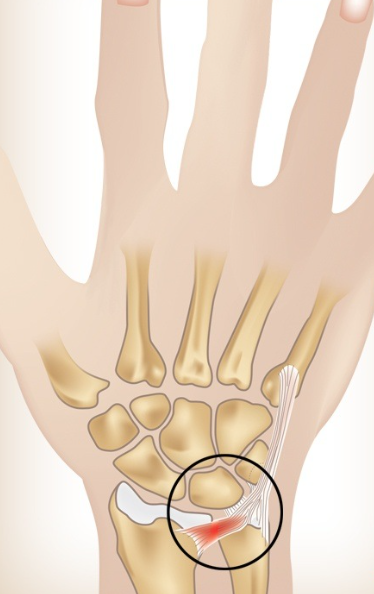 삼각섬유연골복합체(TFCC) 손상 ( 손목통증/손목염좌/테니스손목/골프손목) : 네이버 블로그