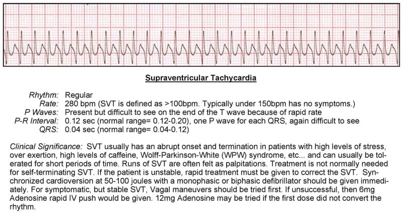 제세동기 : Defbrillation과 Cardioversion : 네이버 블로그