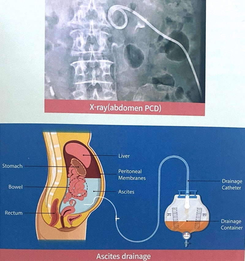 [응급실 간호] 배액관 2편. PCD, PTBD, PTGBD, ENBD, PAD 배액관 총정리 : 네이버 블로그