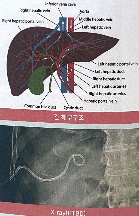 [응급실 간호] 배액관 2편. PCD, PTBD, PTGBD, ENBD, PAD 배액관 총정리 : 네이버 블로그