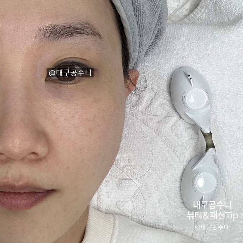피부과 여드름 흉터 없애는법 4가지 네이버 블로그