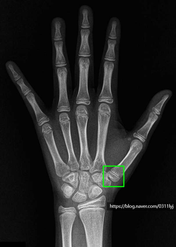 근골격계 손목 의학용어/약어 (DP, MP, PP, RADIUS, ULNA, MC, CARPAL) : 네이버 블로그