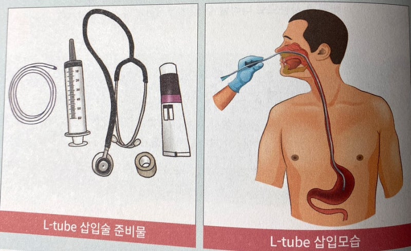 [응급실 간호] Levin tube(L-tube), PEG tube 위관영양, 배액법 및 총정리 : 네이버 블로그