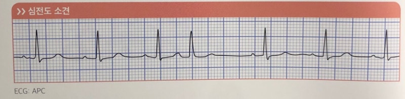 심방조기수축 : 의학용어 APC, PAC / atrial premature contraction EKG 리듬 / 심방조기박동 ...