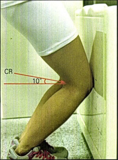 Knee AP,PA,ROSENBERG(Both Lat, Merchant)촬영법 무릎관절 X-RAY검사법 소개 : 네이버 블로그