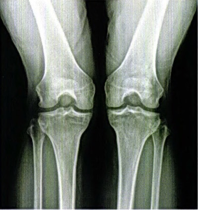 Knee AP,PA,ROSENBERG(Both Lat, Merchant)촬영법 무릎관절 X-RAY검사법 소개 : 네이버 블로그