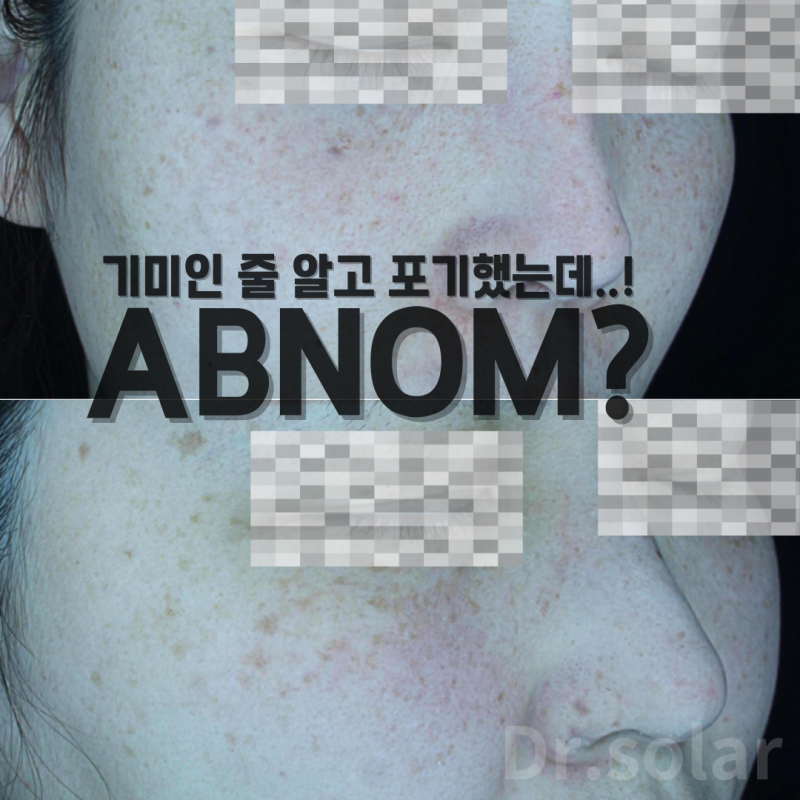 ABNOM(애브넘)후천성양측성오타모반, 평생 기미인 줄 알고 살았더니 치료가 가능하다? : 네이버 블로그
