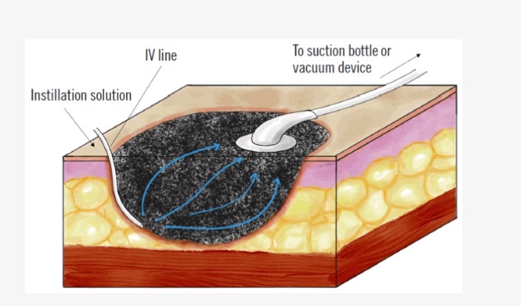 Curavac(큐라박)치료법에 대해 : 네이버 블로그