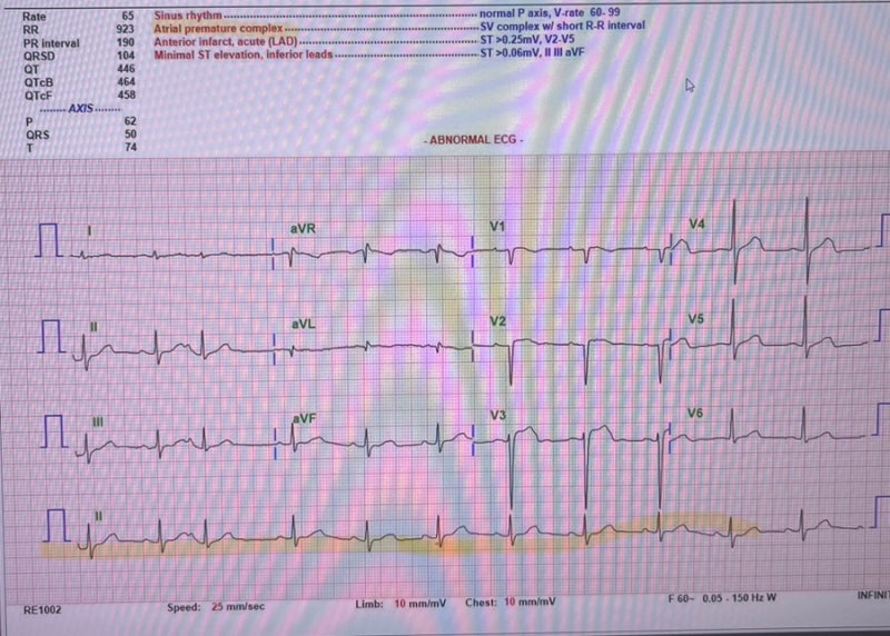심방조기수축 : 의학용어 APC, PAC / atrial premature contraction EKG 리듬 / 심방조기박동 ...