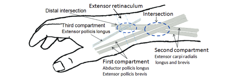 손목 교차 증후군 - proximal, distal intersection syndrome : 네이버 블로그