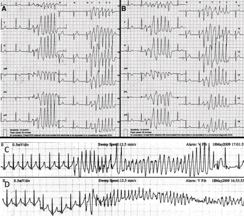 Polymorphic VT (심실빈맥)와 monomorphic VT의 구분 : Uniform, Identical (비슷한 ...
