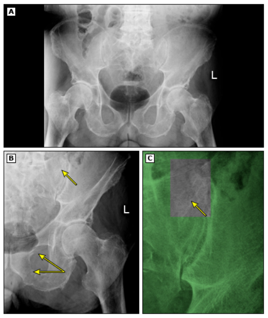 Minor pelvic fractures (경미한 골반 골절), Pubic ramus Fracture. : 네이버 블로그