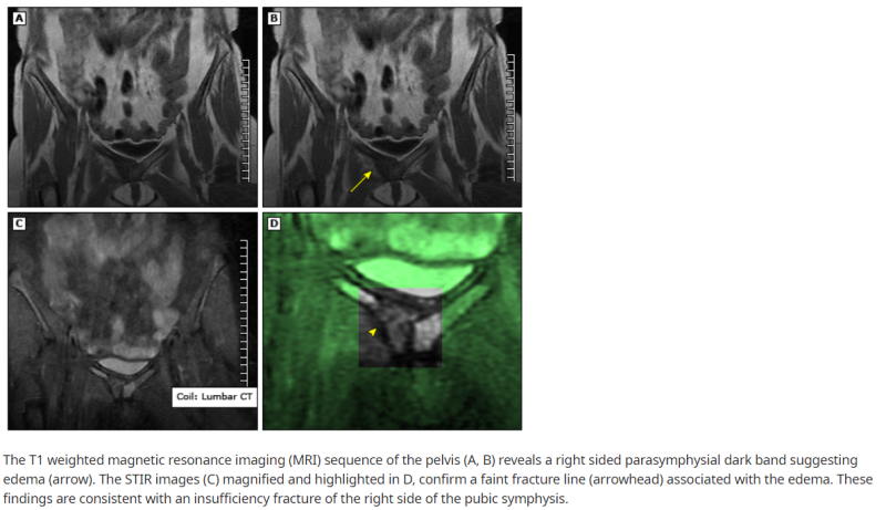 Minor pelvic fractures (경미한 골반 골절), Pubic ramus Fracture. : 네이버 블로그
