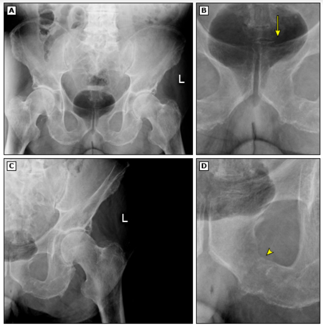 Minor pelvic fractures (경미한 골반 골절), Pubic ramus Fracture. : 네이버 블로그