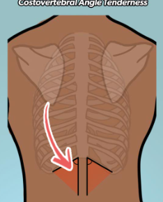 복부진찰 용어 정리 : CVAT, rovsing sign, obturator sign, psoas sign, Murphy ...