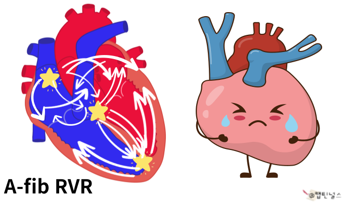 A-fib RVR EKG 모양 및 특징 그리고 PSVT와 A-fib RVR 차이점 : 네이버 블로그