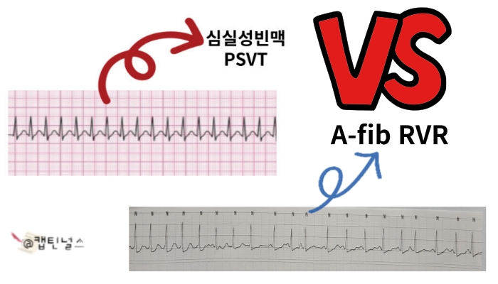 A-fib RVR EKG 모양 및 특징 그리고 PSVT와 A-fib RVR 차이점 : 네이버 블로그