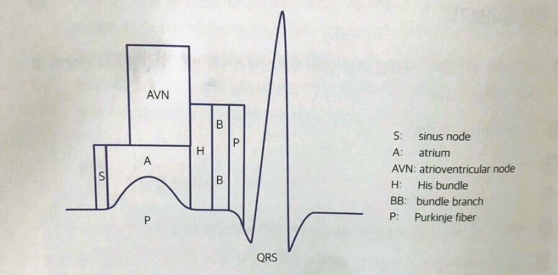 2도 방실차단 : 의학용어 AV block, Mobitz 1,2형 차이점 / 심전도 EKG 리듬 : 네이버 블로그