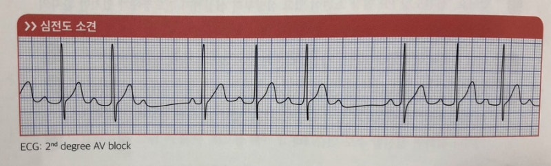 2도 방실차단 : 의학용어 AV block, Mobitz 1,2형 차이점 / 심전도 EKG 리듬 : 네이버 블로그