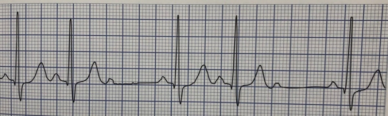2도 방실차단 : 의학용어 AV block, Mobitz 1,2형 차이점 / 심전도 EKG 리듬 : 네이버 블로그