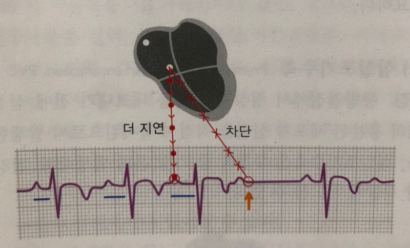 2도 방실차단 : 의학용어 AV block, Mobitz 1,2형 차이점 / 심전도 EKG 리듬 : 네이버 블로그